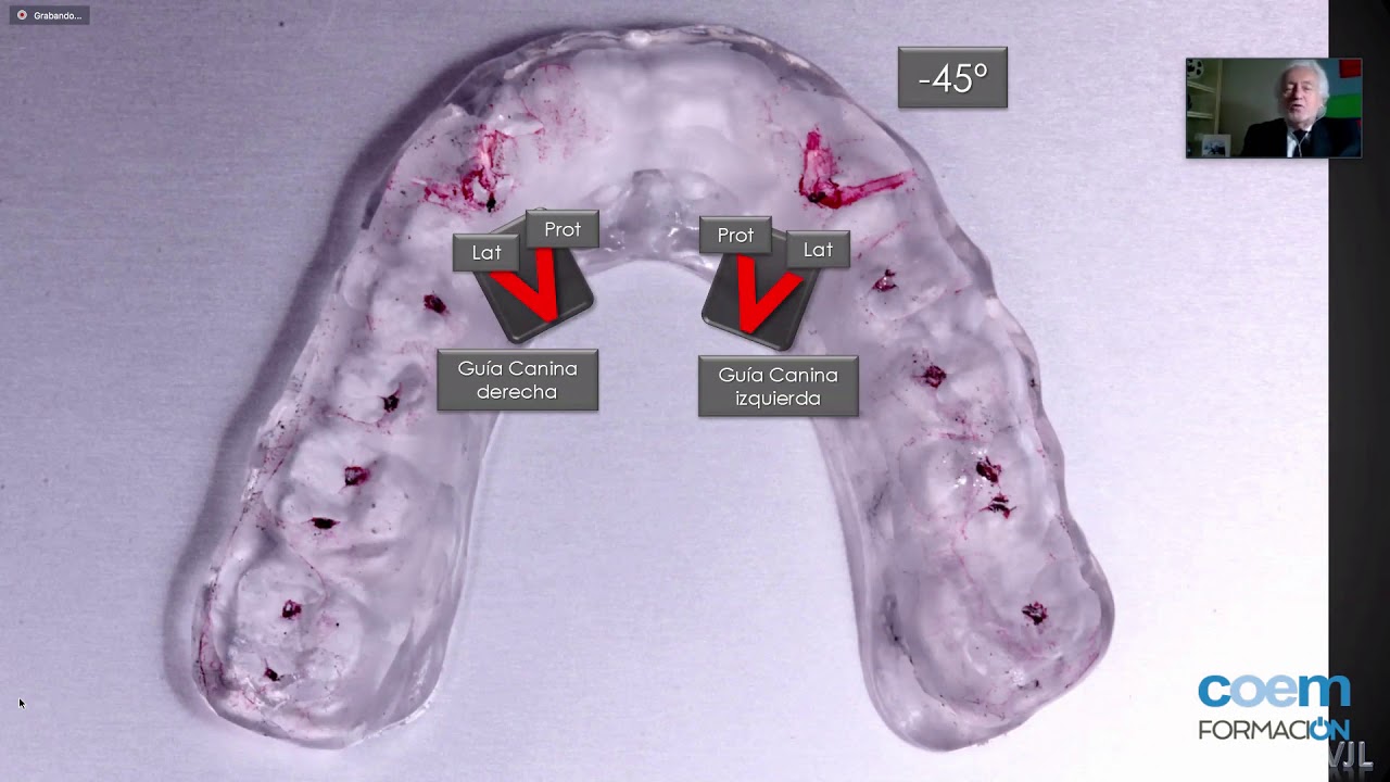Férulas oclusales: su diseño y ajuste (2ª Parte) | Dr. Vicente Jiménez ...