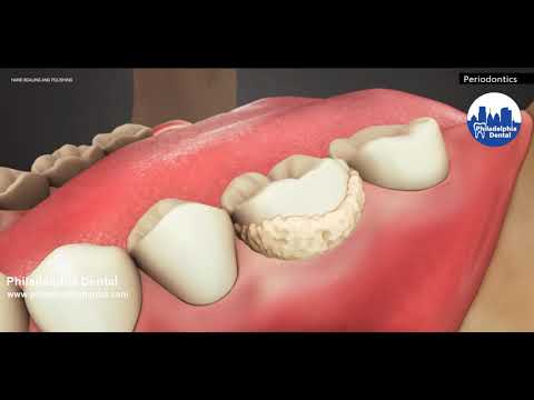 Professional Cleaning (Adult Prophylaxis) - Philadelphia Dental - YouTube