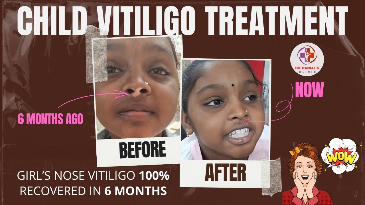 Girl’s Nose Vitiligo 100% Recovered in 6 Months | Dr. Danial’s Kids ...