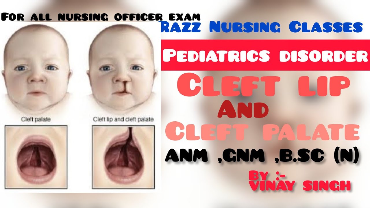 Cleft lip or Cleft palate || free Nursing classes || Razz nursing classes || pediatric - YouTube