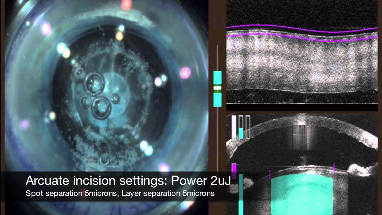 Arcuate incisions: Getting it just right - YouTube