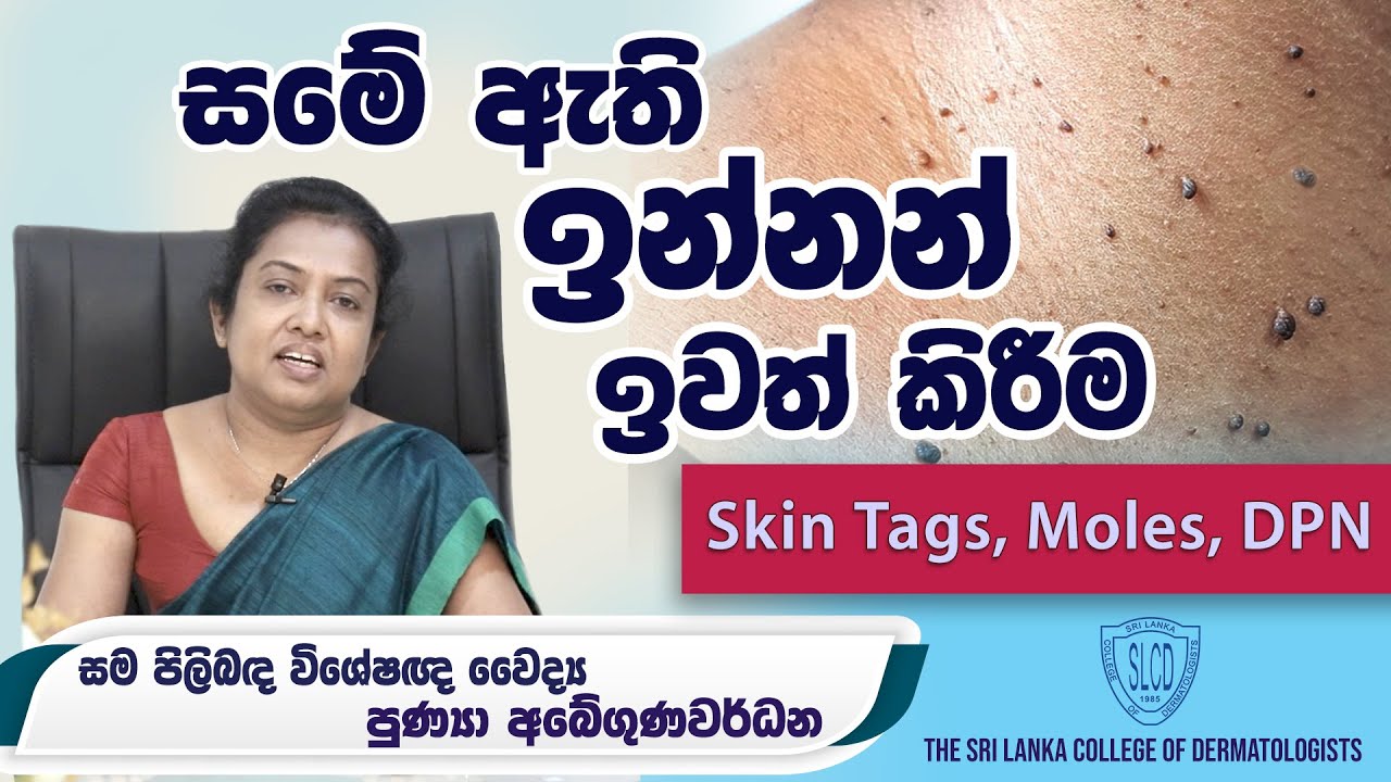 Warts, Skin Tags, Moles and DPN (සමේ ඇති ඉන්නන් ඉවත් කිරීම) : Dr. Punya ...