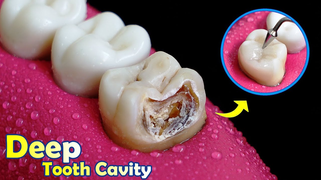FANTASTIC Restoration Of Tooth Cavity By Root Canal And Composite ...