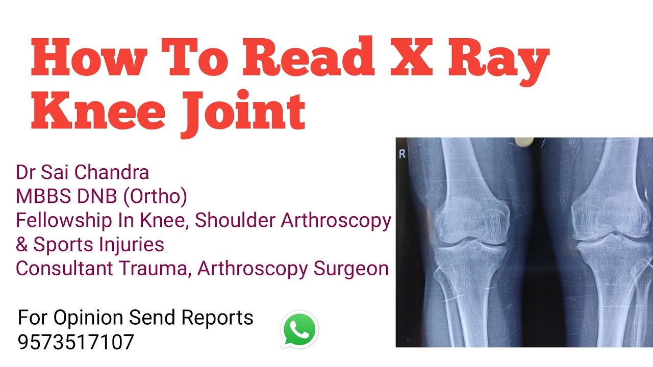 How To Read Knee Joint X Ray...Dr Sai Chandra MBBS DNB (Ortho) - YouTube