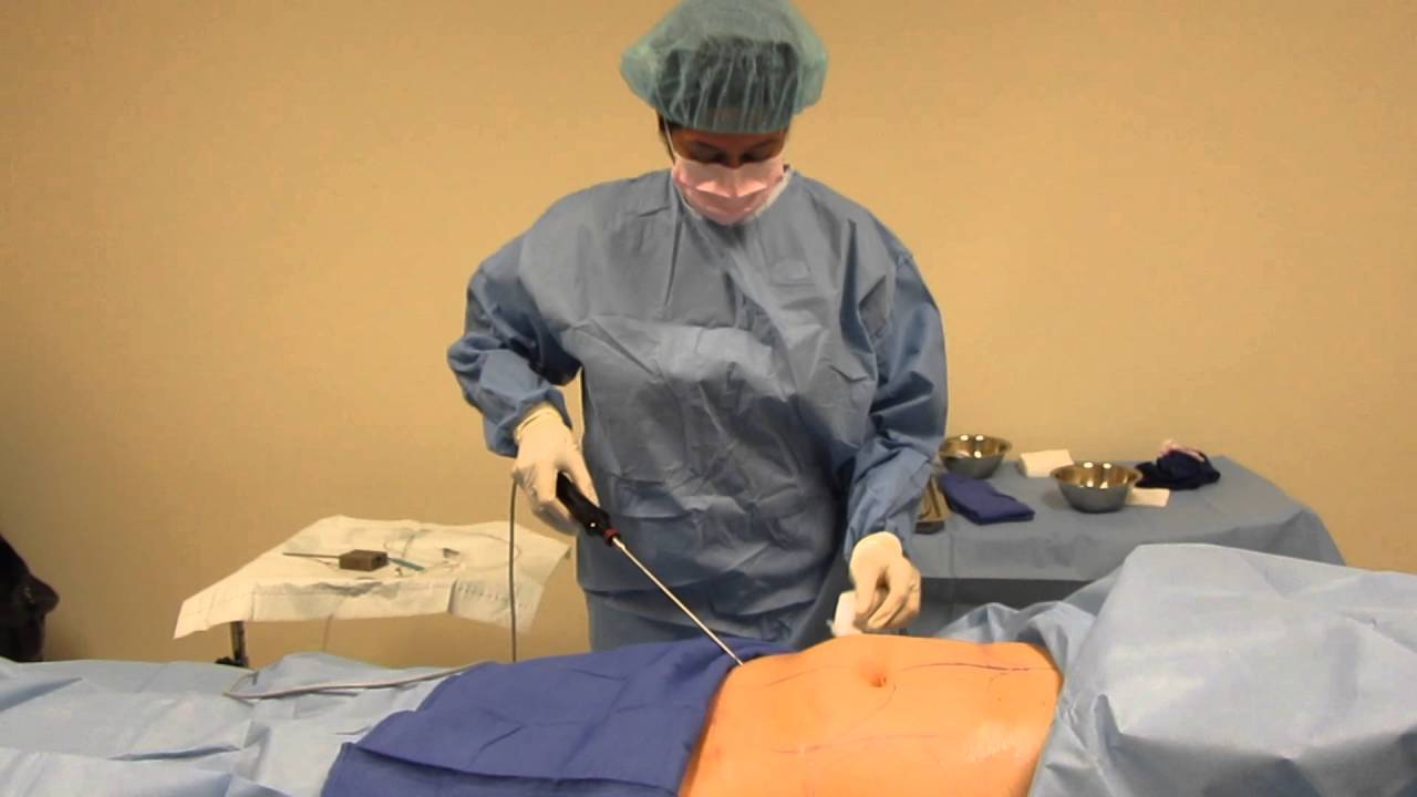 Minimally invasive awake liposuction - YouTube