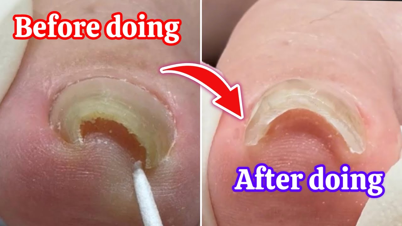 Turn crooked nails into straight ones, relaxing. - YouTube