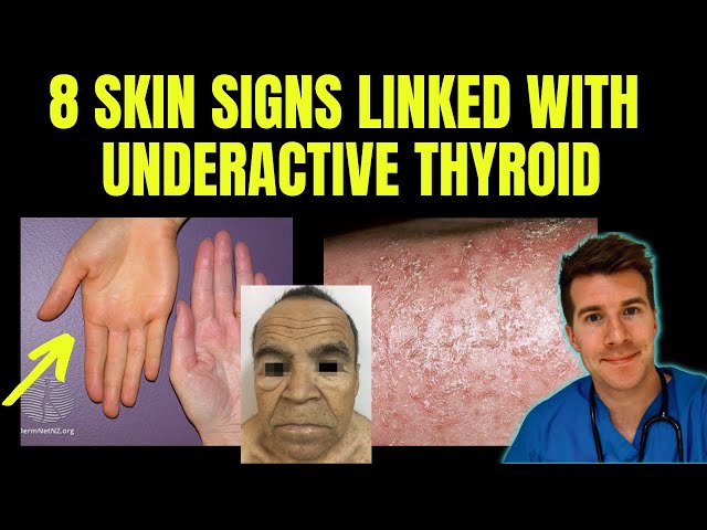 Hypothyroidism Dry Skin