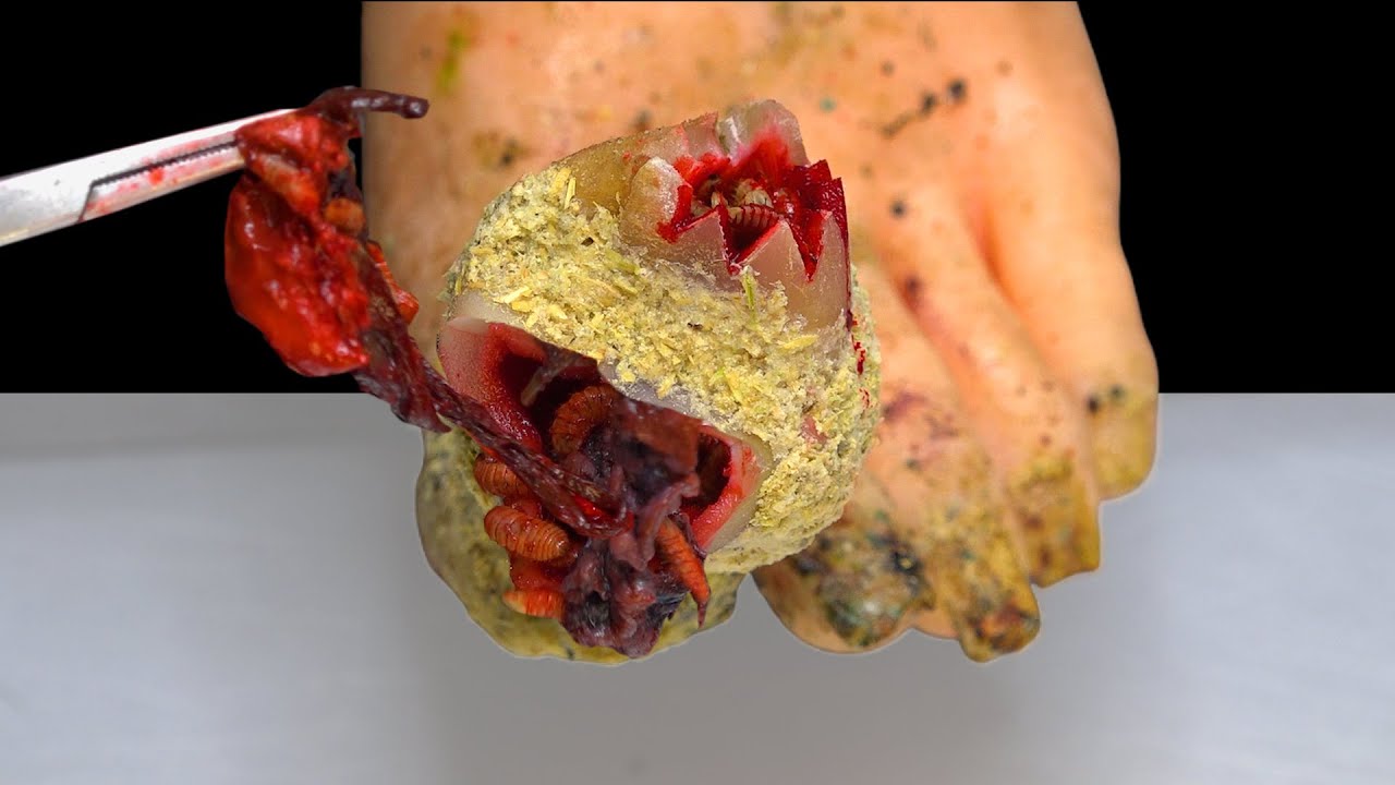 SHOCKED Ingrown Toenail Treatments 👣 Fungal Toenails 👣 Toenail Foreign ...