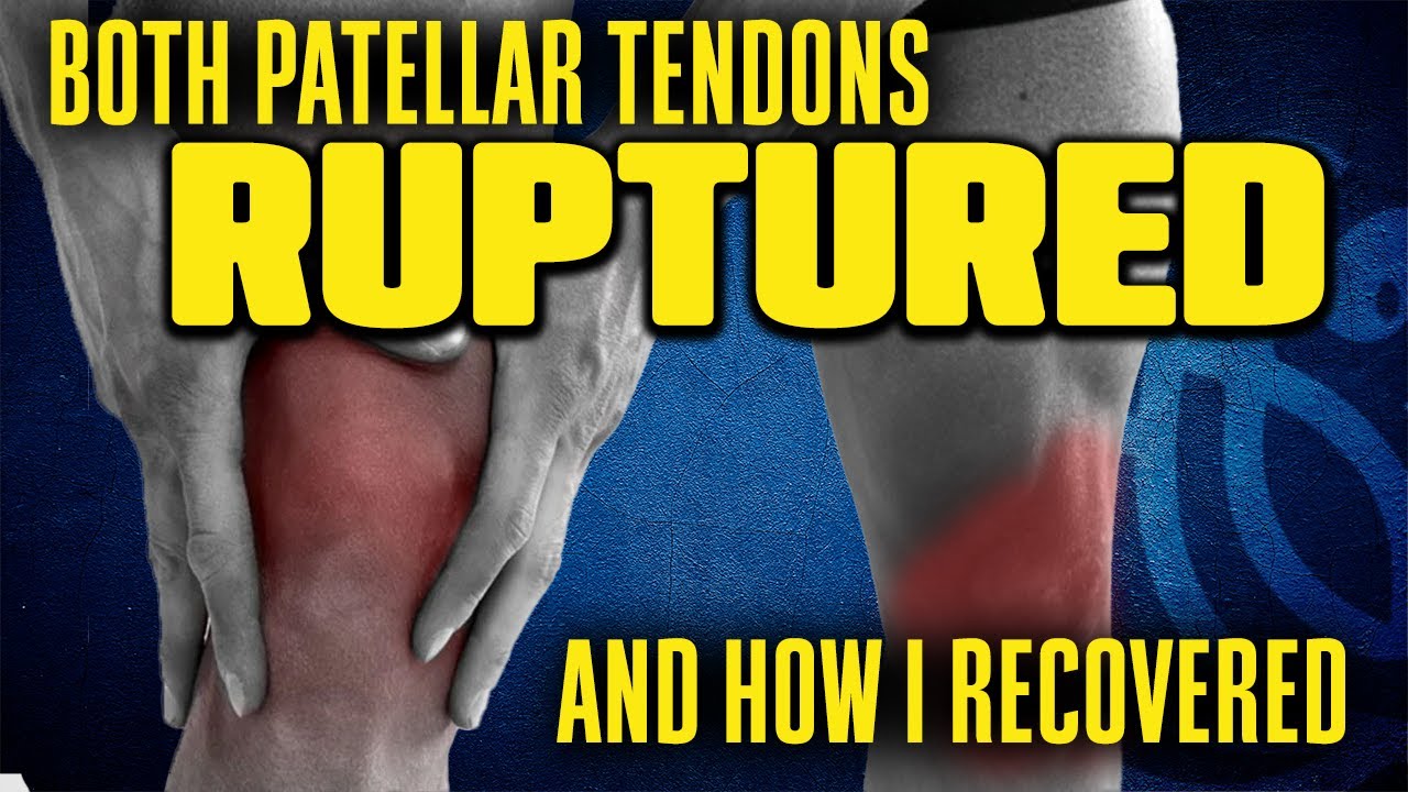 Conquering Patellar Tendon Ruptures: My Journey and Recovery Guide ...
