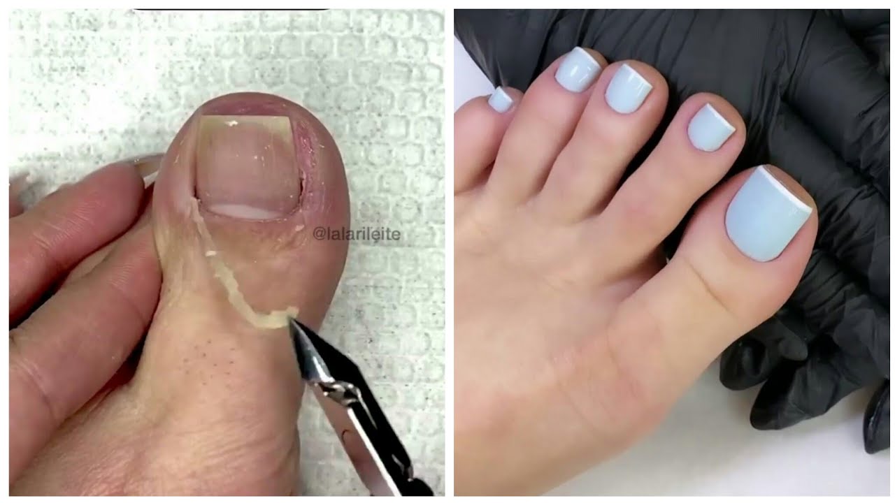 Most Satisfying Pedicure Transformation 😱 best nail polish for toes ...
