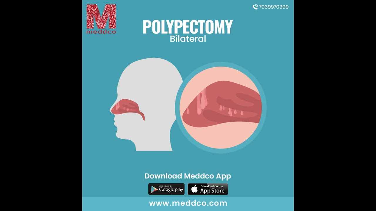 Polypectomy - Bilateral. Introduction| Causes| Symptoms| Treatment ...