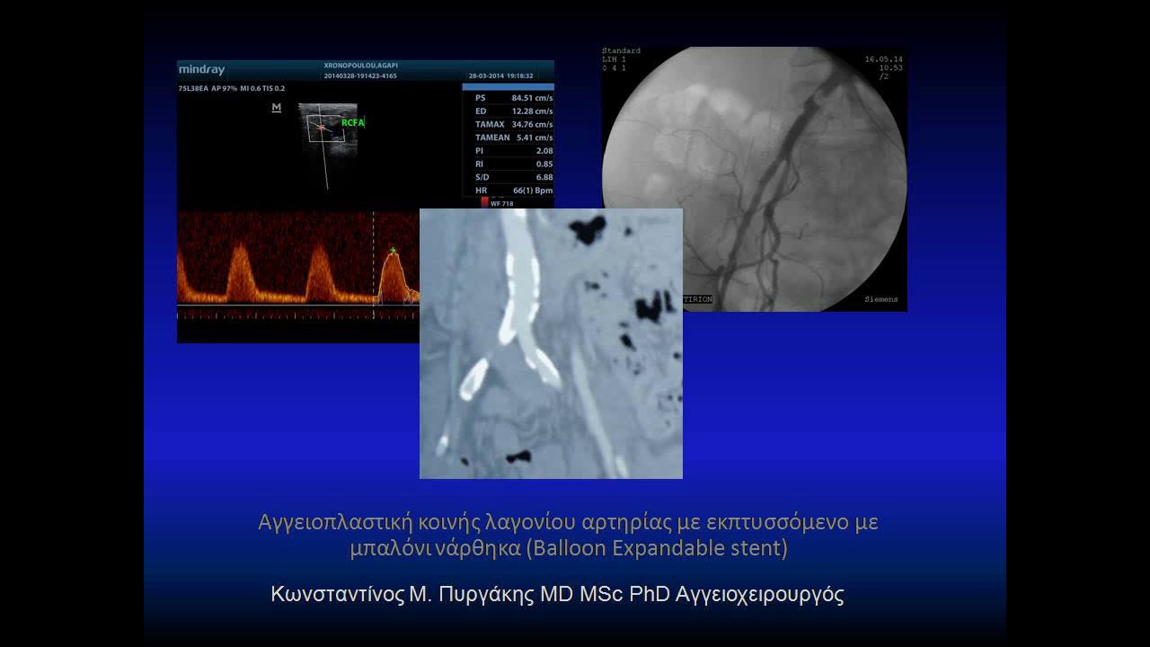 Video Αγγειοπλαστικής κοινής λαγονίου αρτηρίας - YouTube