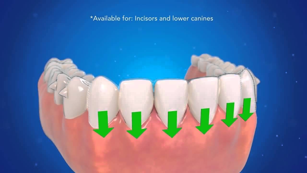Invisalign Antes E Depois Da Mordida Invisalign: O Guia Completo Para