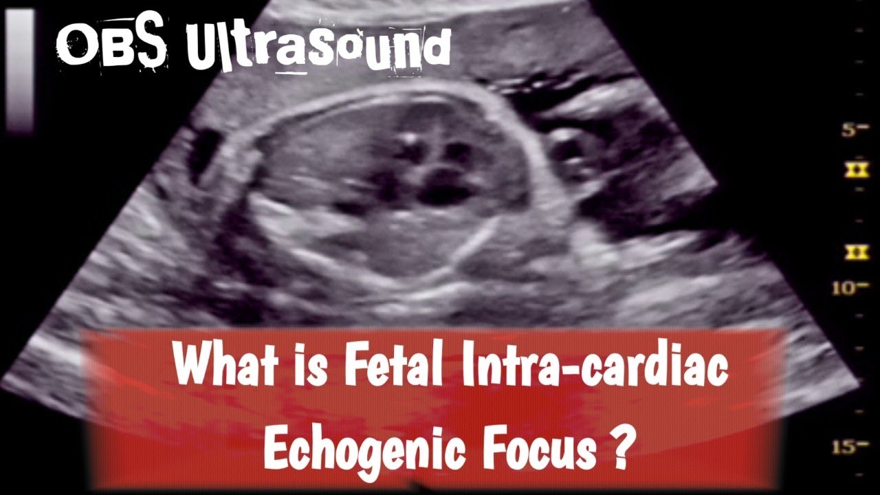 Ultrasound Pregnancy What Is Fetal Echogenic Cardiac Focus Youtube