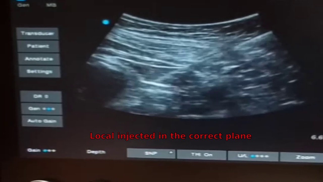 Quadratus Lumborum Ql3 Block Usg Guided Youtube