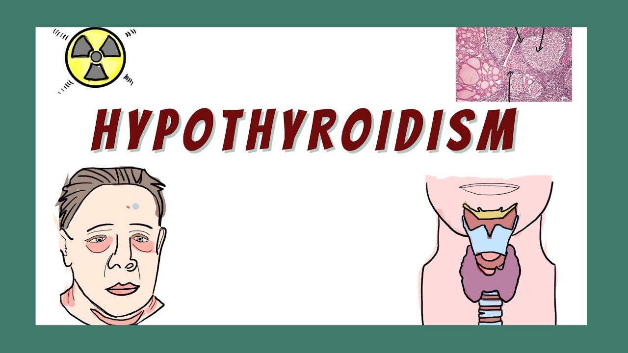 Hypothyroidism and Hashimoto's Thyroiditis - Pathophysiology, causes ...