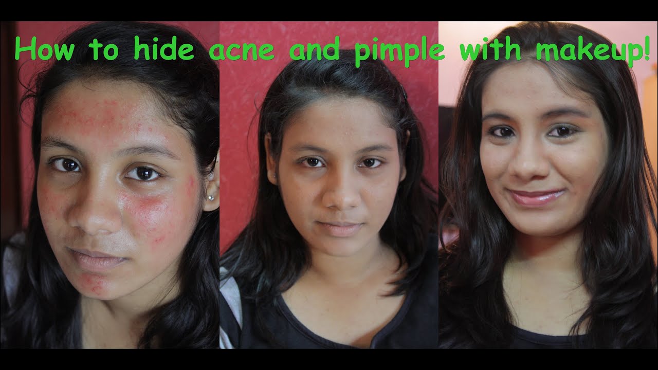 How to hide acne and pimples with makeup- tutorial - YouTube