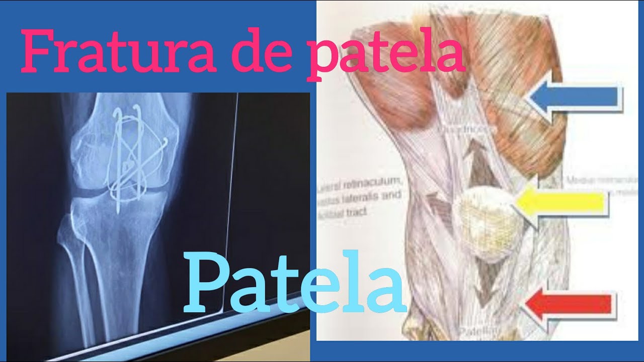 Fratura de patela fisioterapia no pos operatorio - YouTube