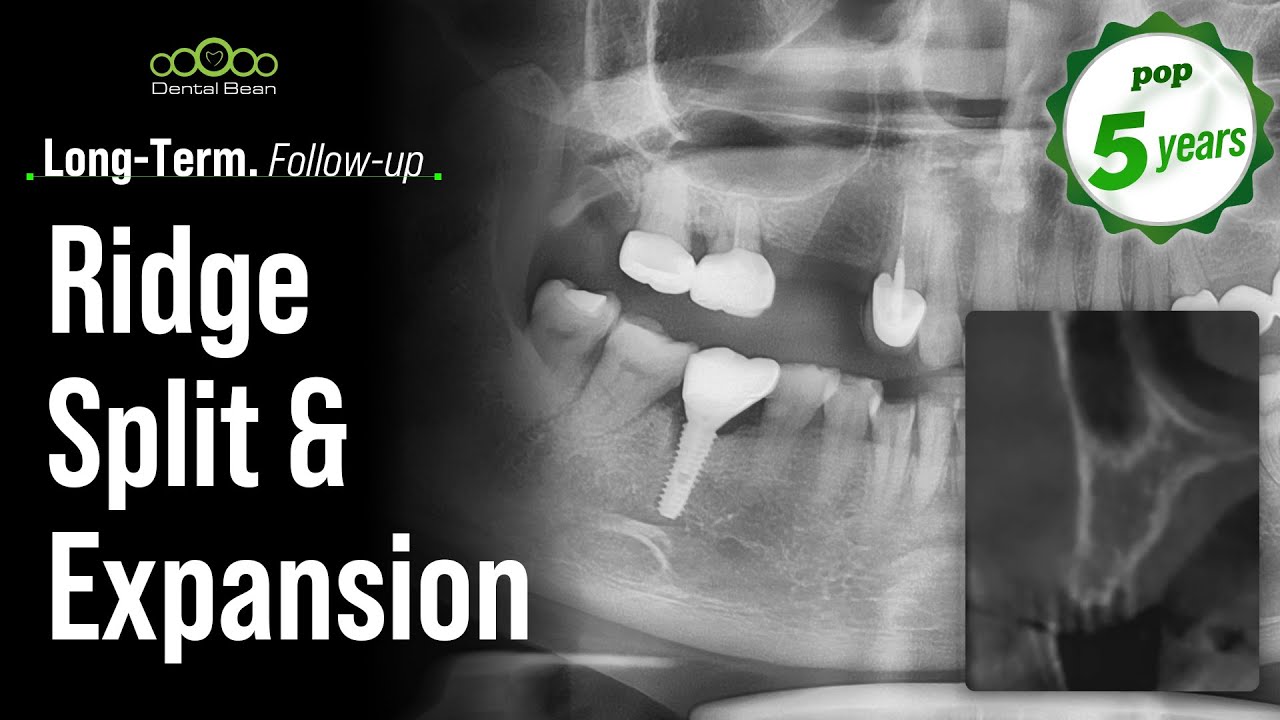 Implant placement with a combination ridge split [Dr. Cho Yongseok ...