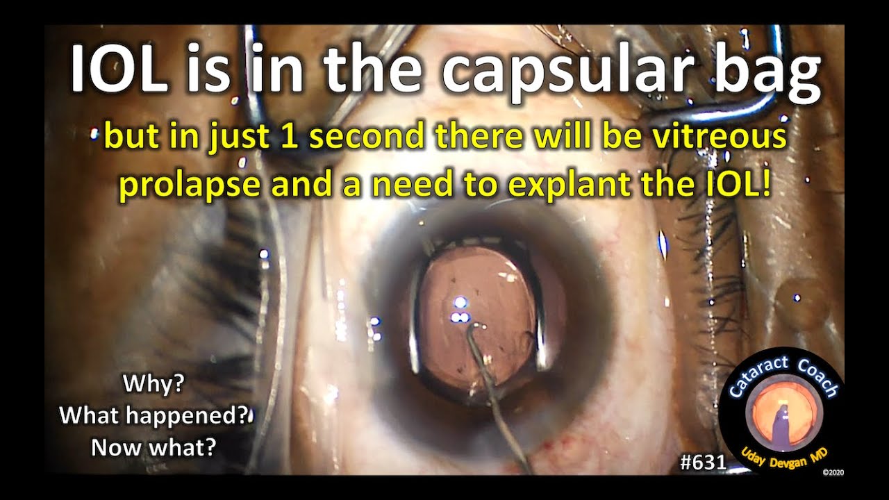 IOL is in the capsular bag but you won't believe what happens in the ...