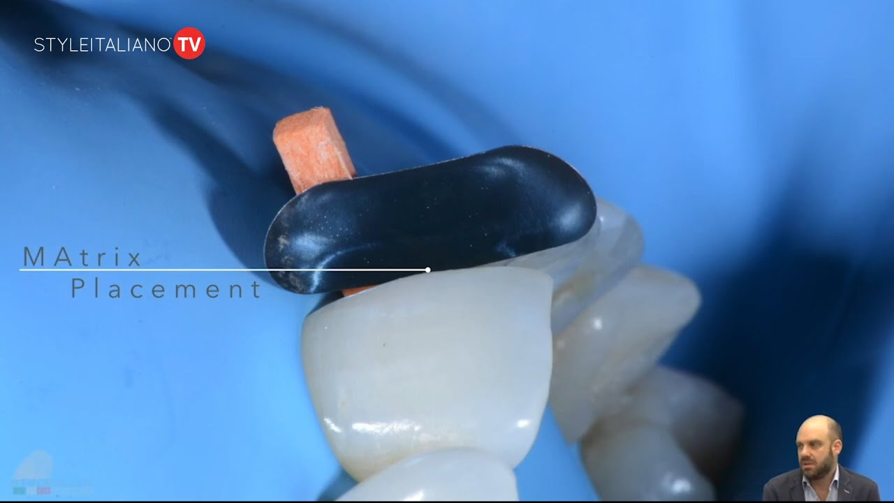 MATRIX PLACEMENT by Dr Jordi Manauta - YouTube
