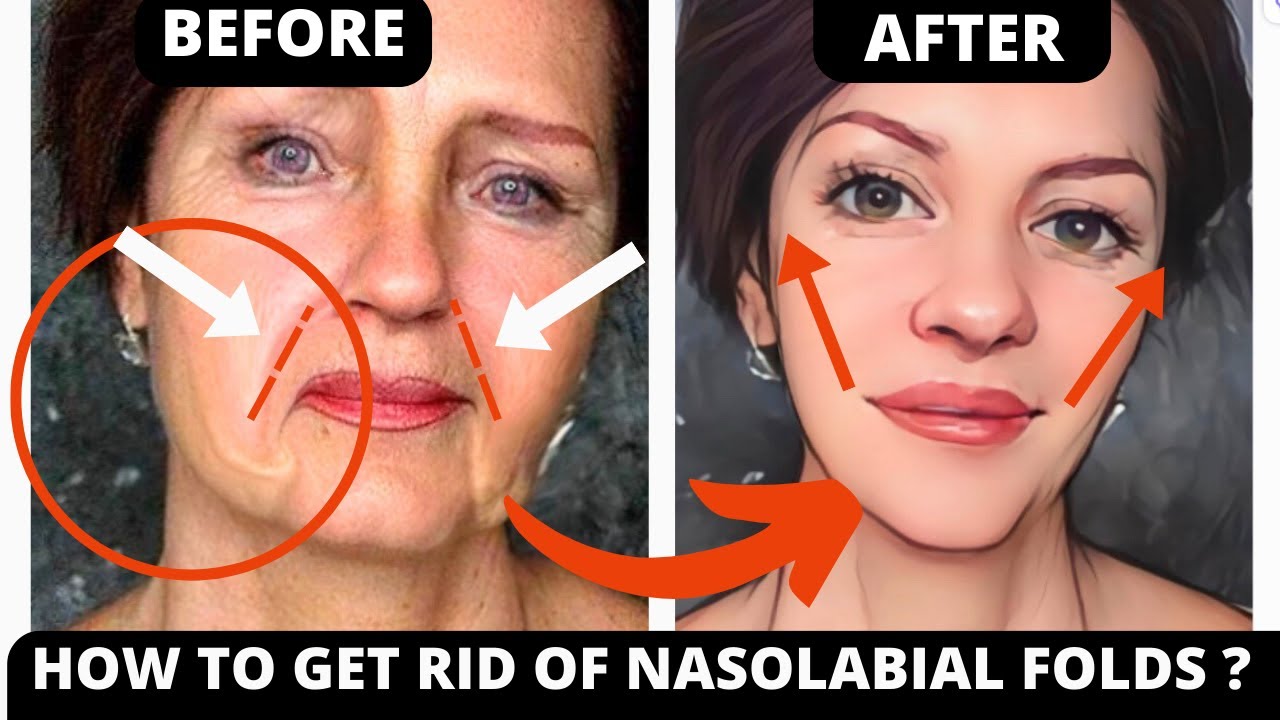 HOW TO GET RID OF LAUGH LINES WITH FACE YOGA ? GET RID OF NASAL FOLDS ...