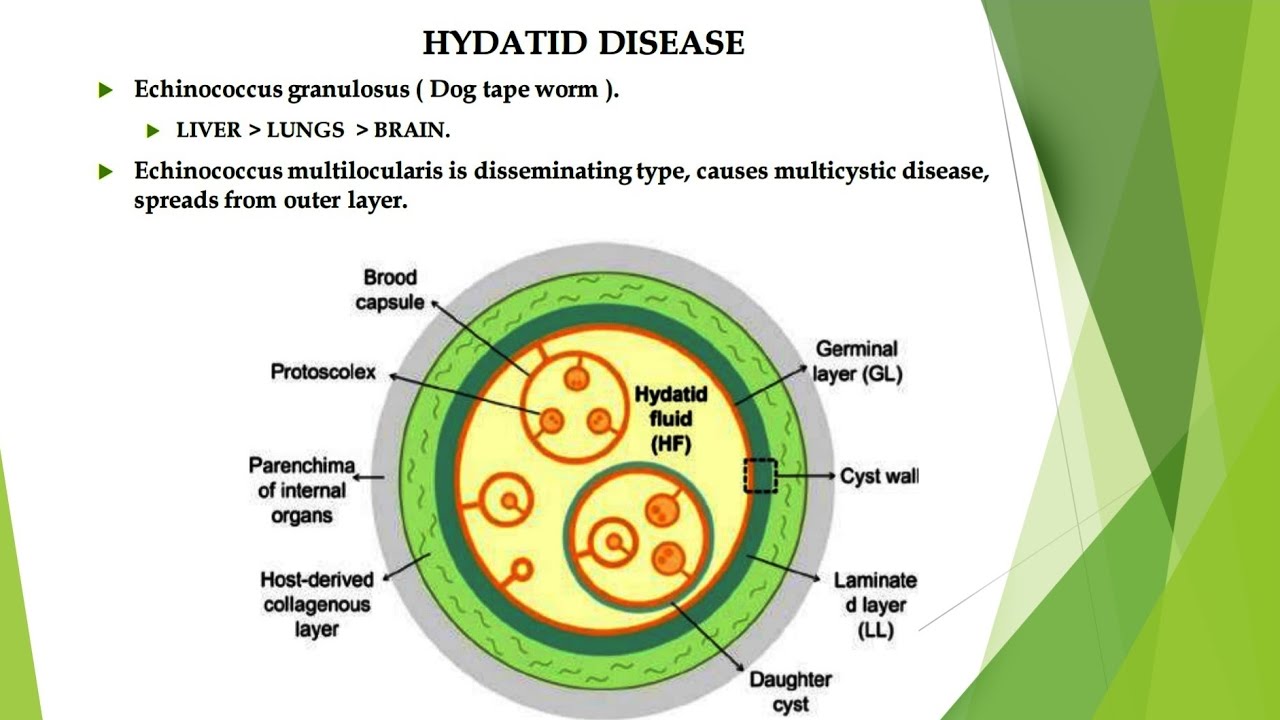 HYDATID CYST LIVER (Part-A) : STRUCTURE, LIFE CYCLE, IWGE GRADING ...