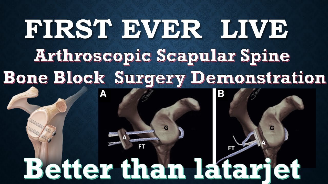 First Ever Live Shoulder Arthroscopic scapular spine bone block with ...
