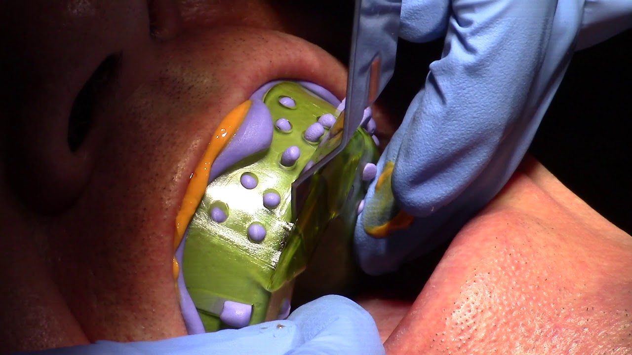 How to take a dental implant impression with a closed tray impression ...