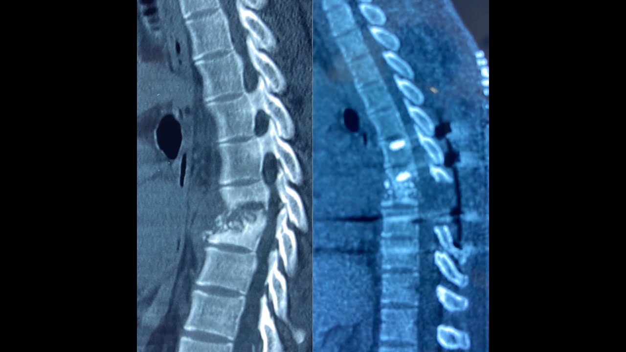 Thoracic fixation & transpedicular decompression . - YouTube