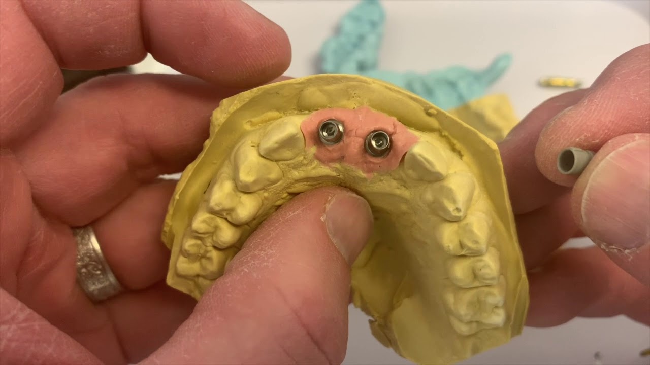 CEREC TiBase Dental Implant Crowns 8 and 9 - Whole Process! - YouTube