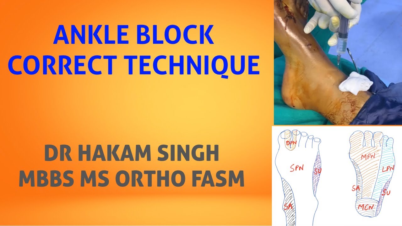 ANKLE BLOCK. DETAILED TECHNIQUE. DR HAKAM SINGH - YouTube