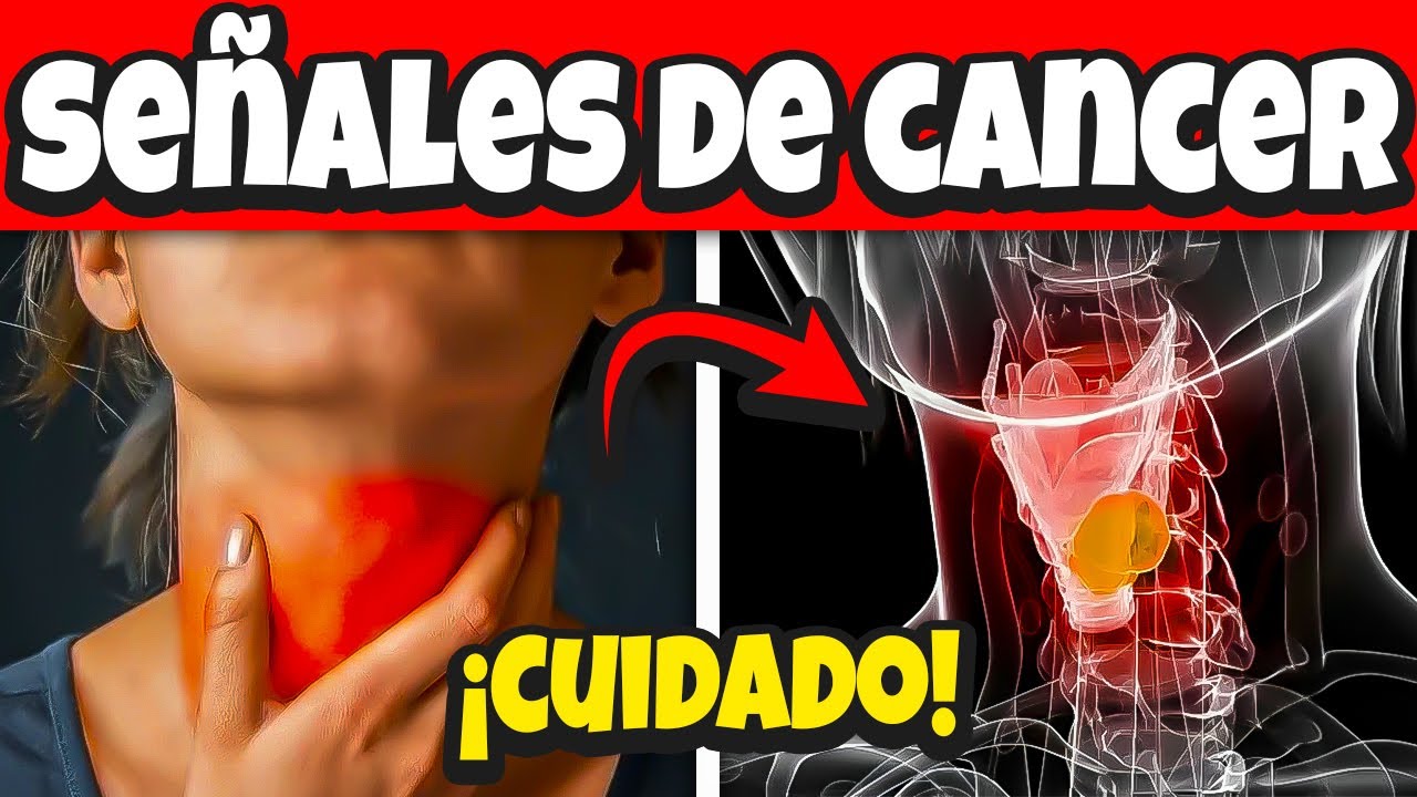 Como Empieza El Cancer De Garganta? Sintomas y detenccion temprana ...