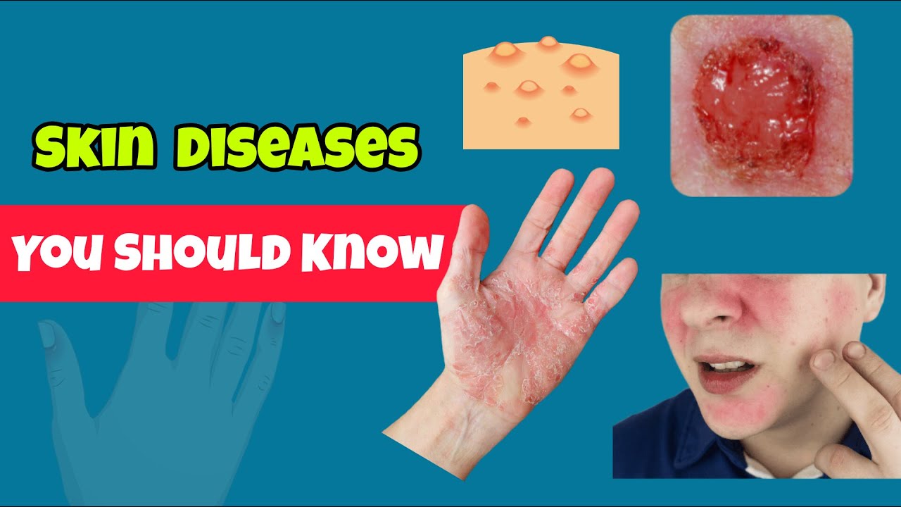 5 Most Inflammatory Skin Conditions: Diagnosis and Treatment | Managing ...