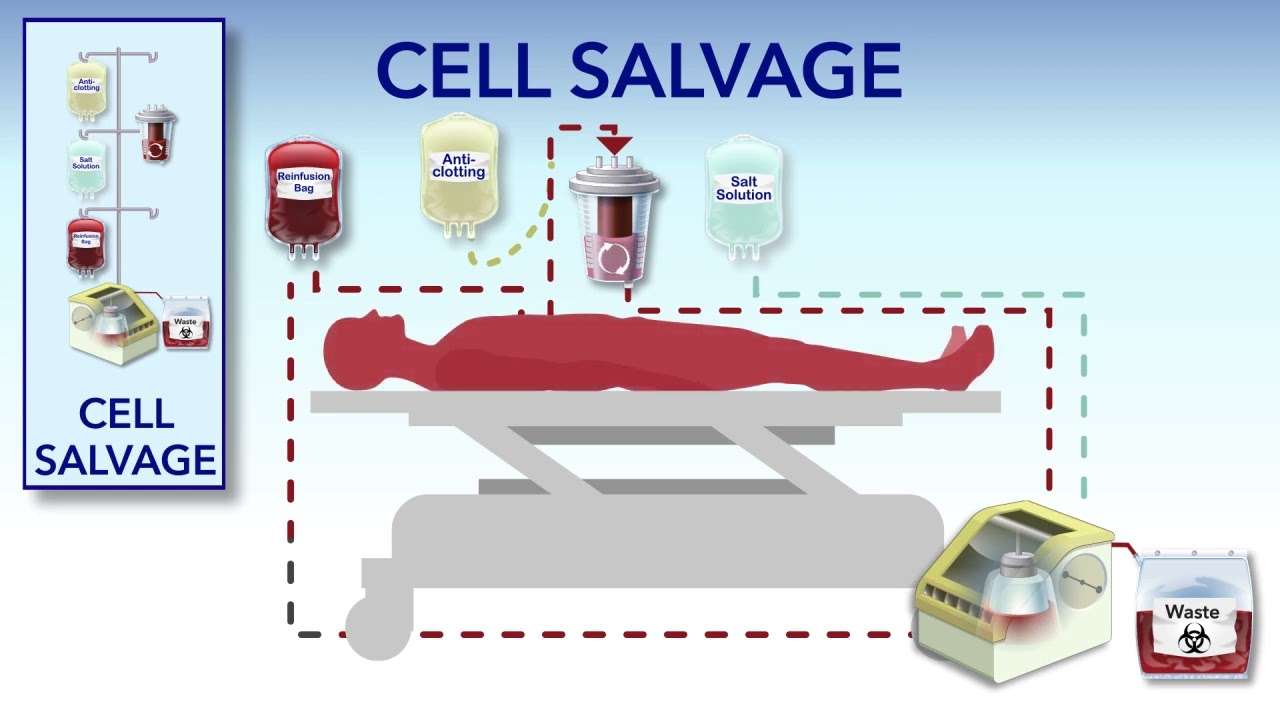 Cell Salvage and Hemodilution - YouTube