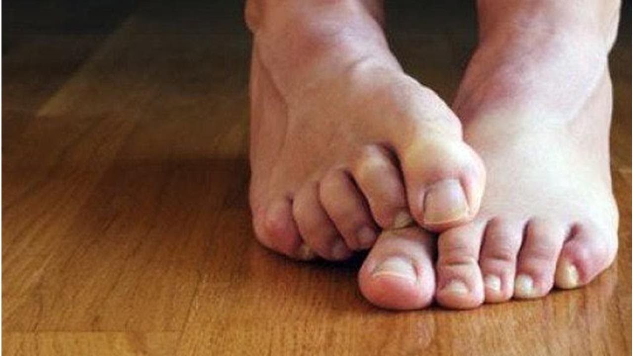 Symptom på fotsvamp och huskurer som fungerar - YouTube