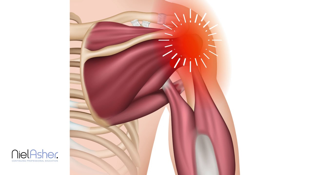 Teres Minor - Trigger Point Anatomy - YouTube