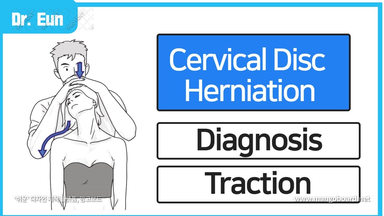 cervical disc herniation and traction - YouTube