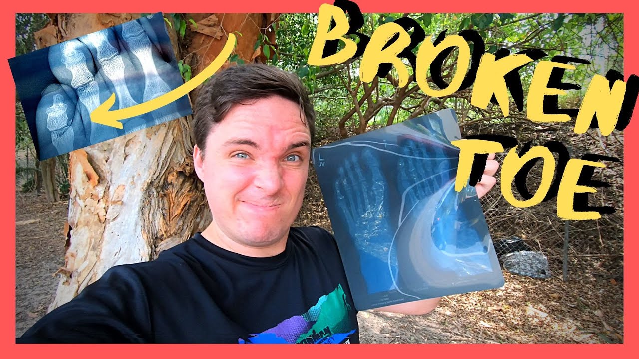 Broken Toe | Buddy Taping | Triathlon Vlog - YouTube