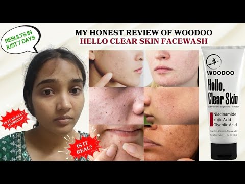 Woodoo Hello Clear Skin Facewash |Does it really work🤔😳 |My honest ...
