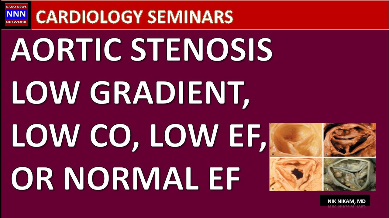 Aortic Stenosis Low Flow Low Gradient Low EF Nik Nikam MD - YouTube