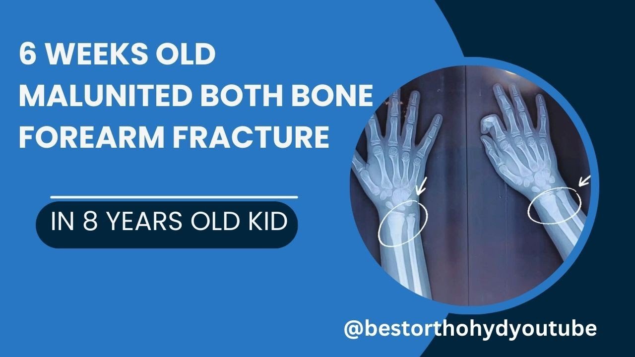 6 WEEKS OLD MALUNITED BOTH BONES FOREARM FRACTURE IN A 8 YR OLD KID ...