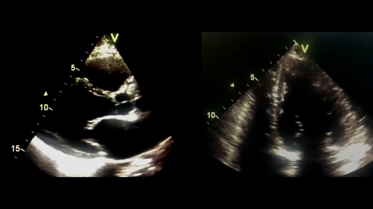 Video 1 Cobalt CM Severe LVSD - YouTube