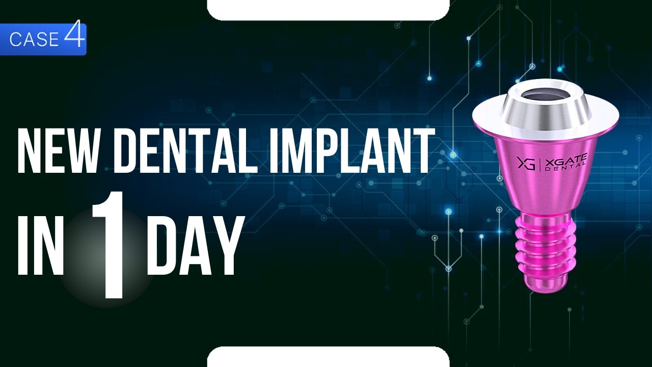 New dental implant in one day. How to use CAD CAM and other advantages ...