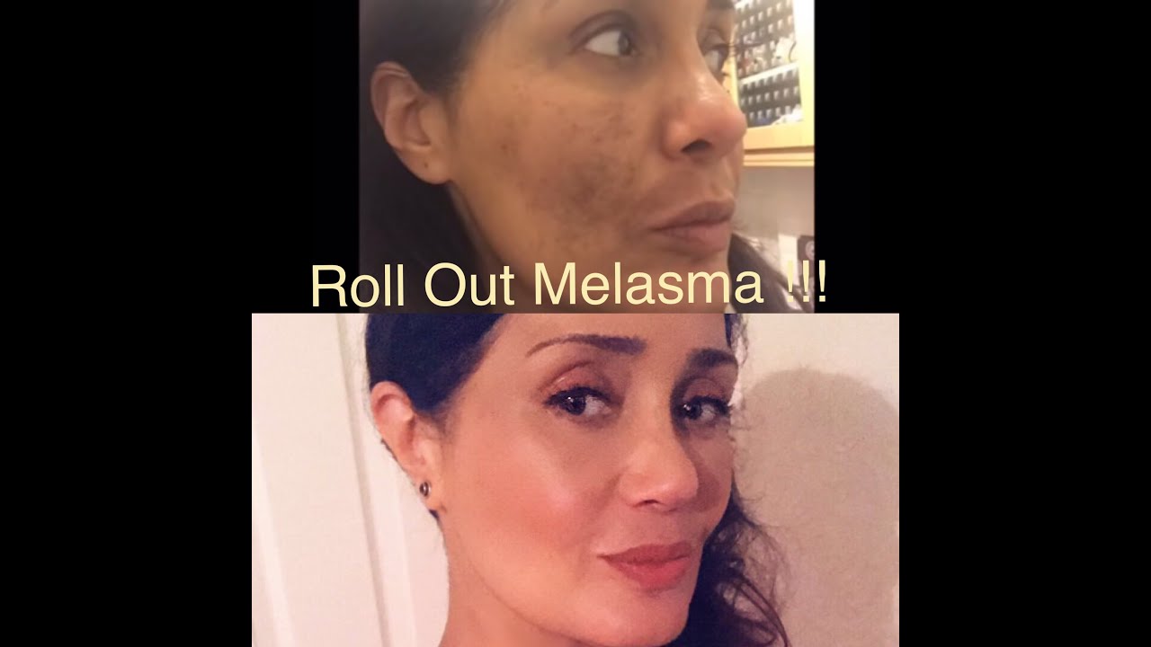 How to Control MELASMA using Derma Roller, Micro Needling. - YouTube