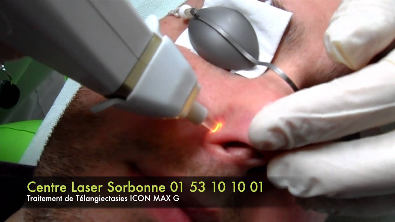 Traitement laser des Telangiectasies par laser ICON MAX G - YouTube