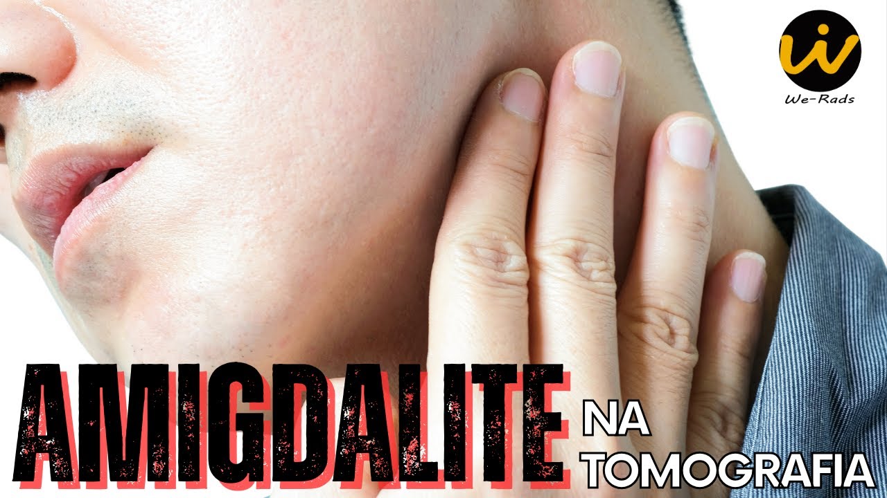 AMIGDALITE - ABSCESSO AMIGDALIANO na Tomografia Computadorizada de ...