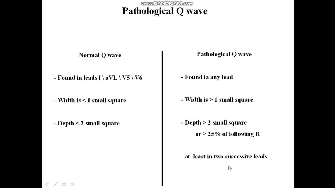 Normal Q wave \ Pathological Q wave - YouTube