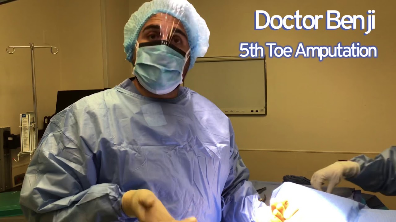Left 5th Toe Amputation - YouTube