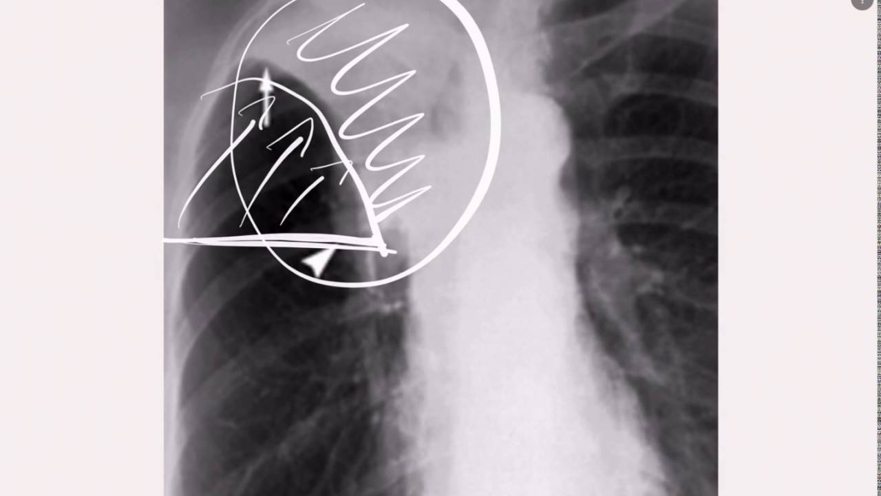 The CXR in Pneumonia - YouTube